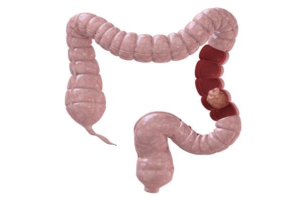 Come riconoscere il sangue nelle feci - 7 passi