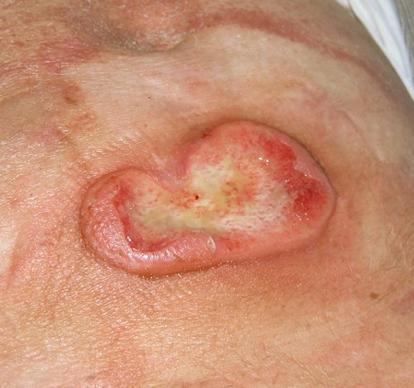 Come curare le piaghe sulla pelle - 4 passi