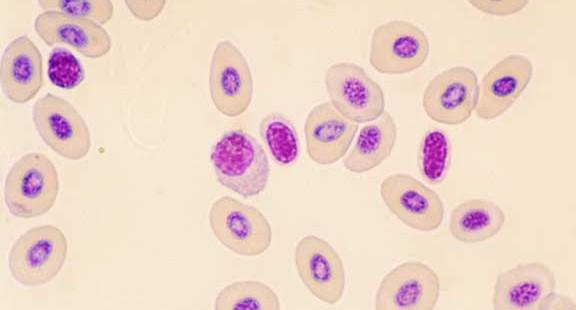 Sintomi delle piastrine basse - 9 passi